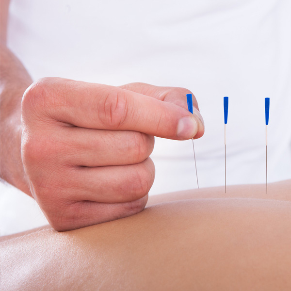 Acupuncture and IMS | InsideOut Physiotherapy & Wellness Group